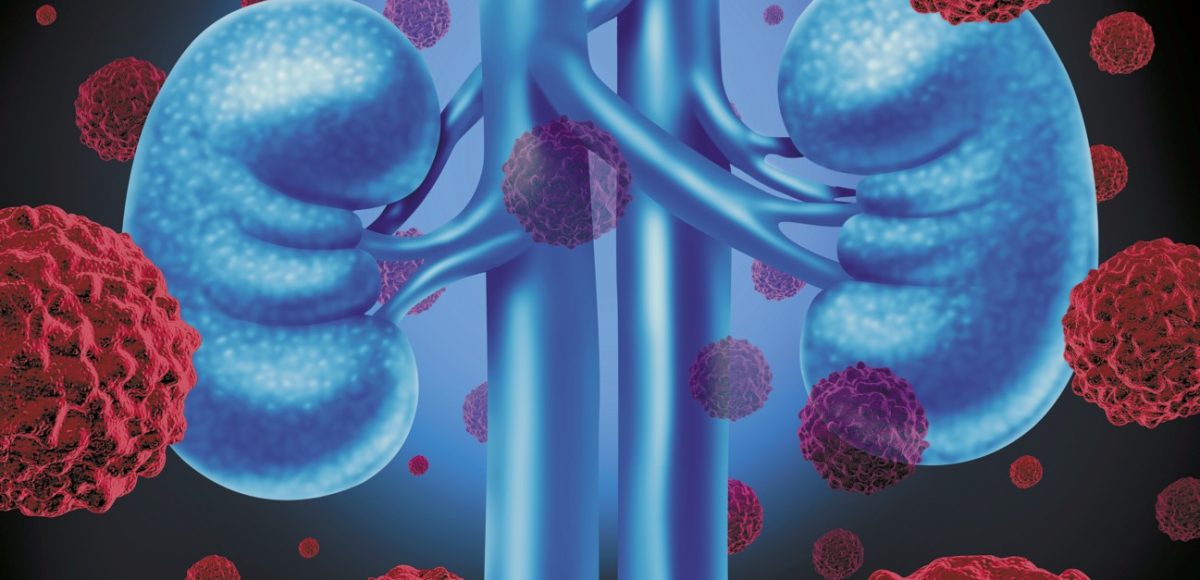 Cancer du rein métastatique : quelles séquences en 2018 ? Quelles ...
