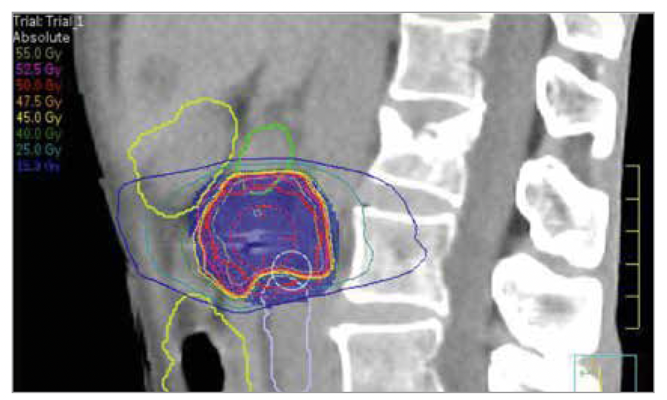 Adénocarcinome du pancréas localement avancé : place de la ...