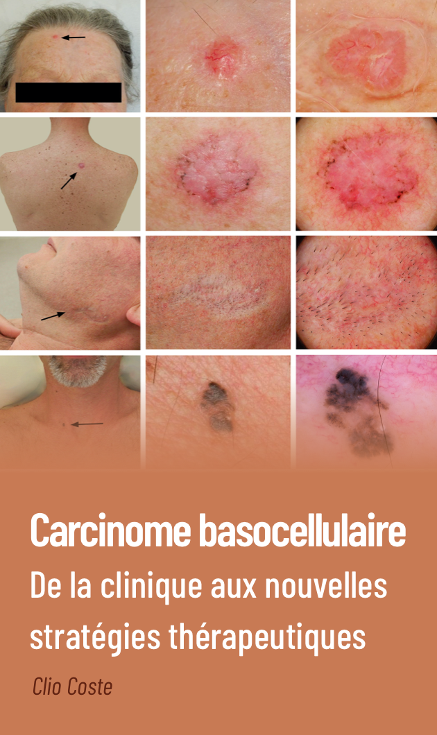 Le carcinome basocellulaire : de la clinique aux nouvelles stratégies ...